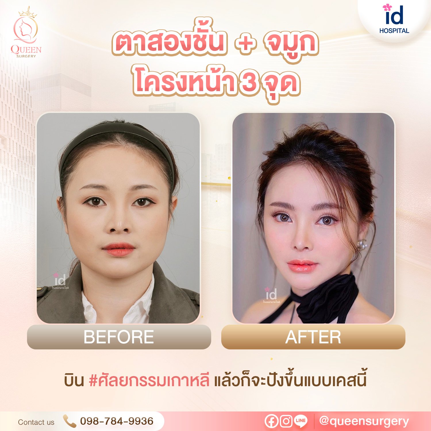 ทำไมต้อง ทำตา + เอ็นโดไทน์ กับ Queen Surgery