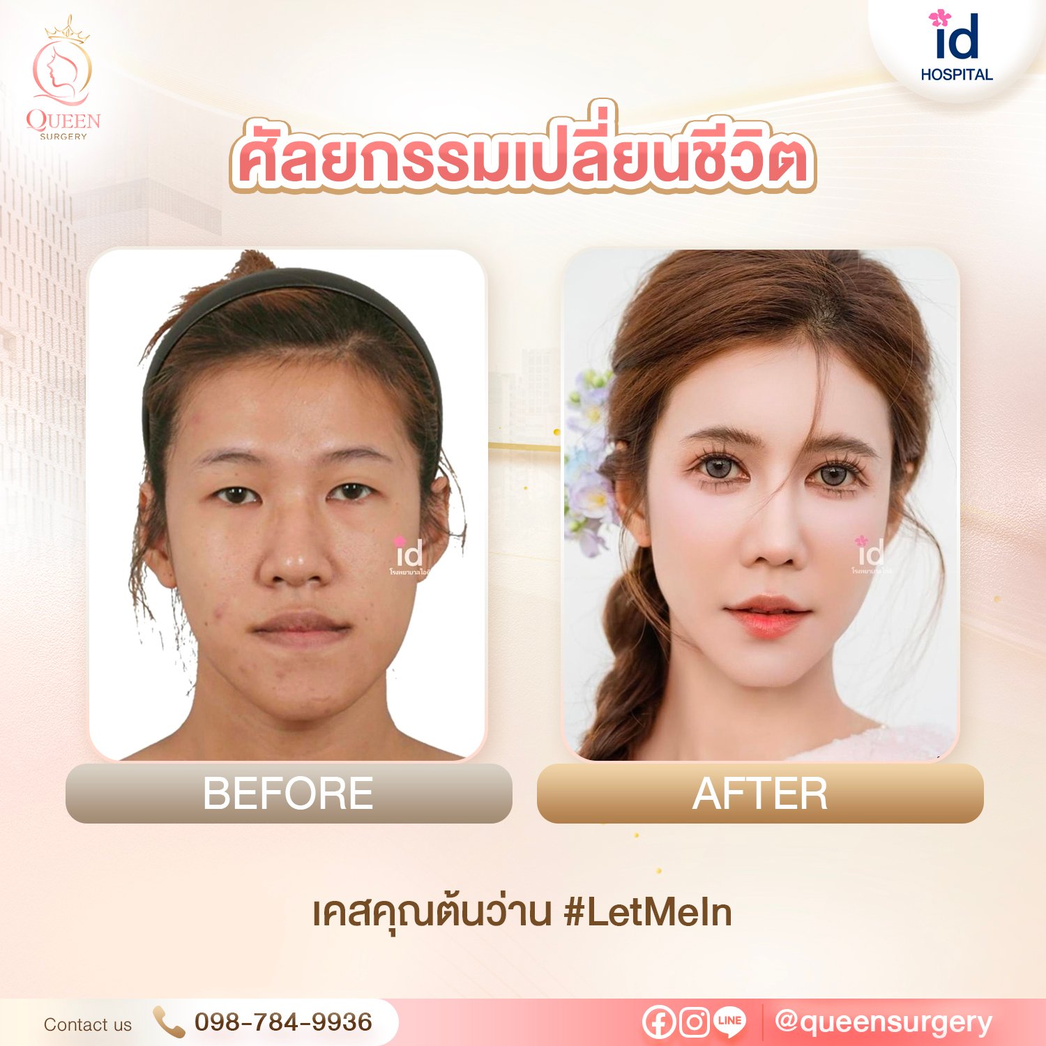 โครงหน้าสามจุด ที่สมบูรณ์แบบที่สุดสำหรับคุณ Queen Surgery