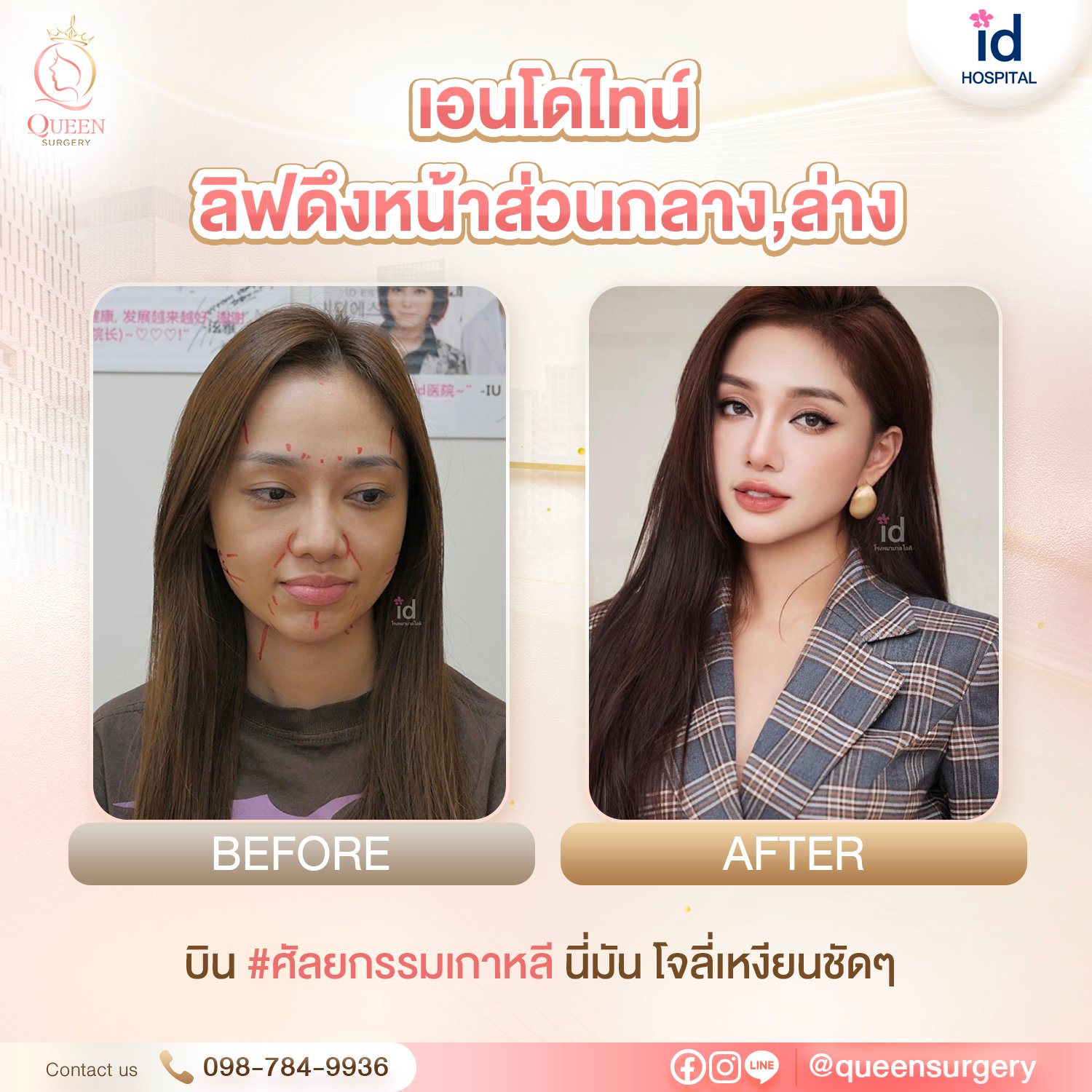 ทำไมต้อง ทำตา + เอ็นโดไทน์ กับ Queen Surgery