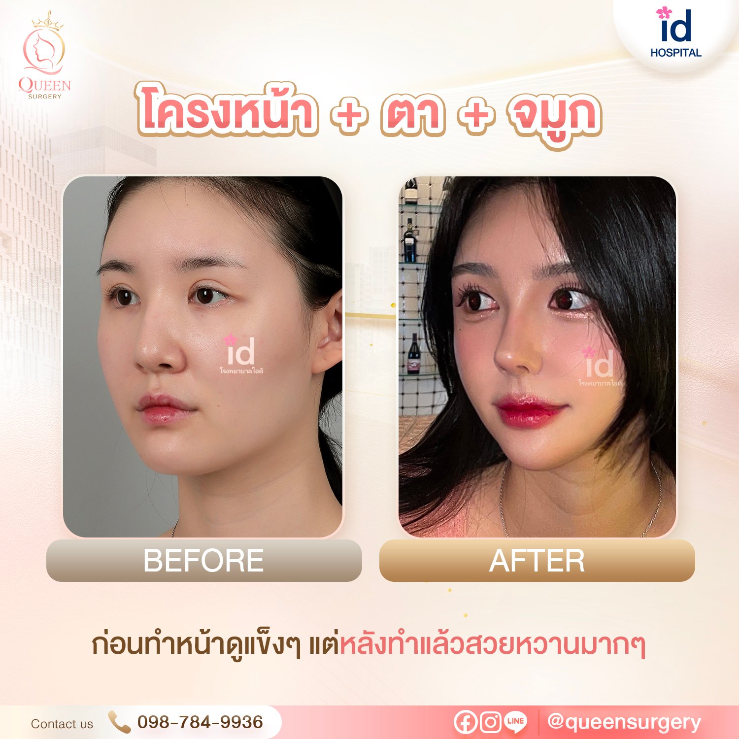 ทำไมต้อง ทำตา + เอ็นโดไทน์ กับ Queen Surgery
