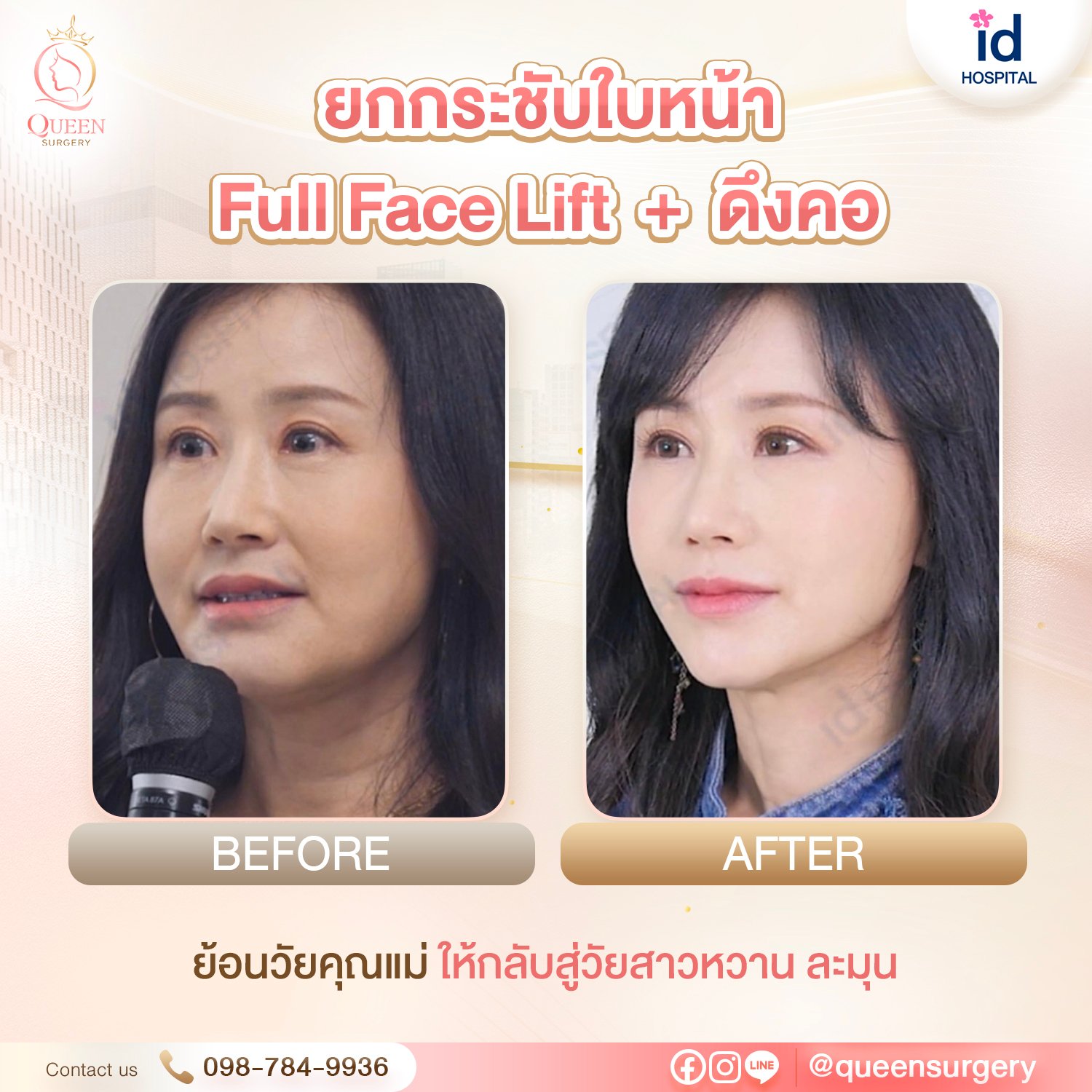 ทำไมต้อง ทำตา + เอ็นโดไทน์ กับ Queen Surgery