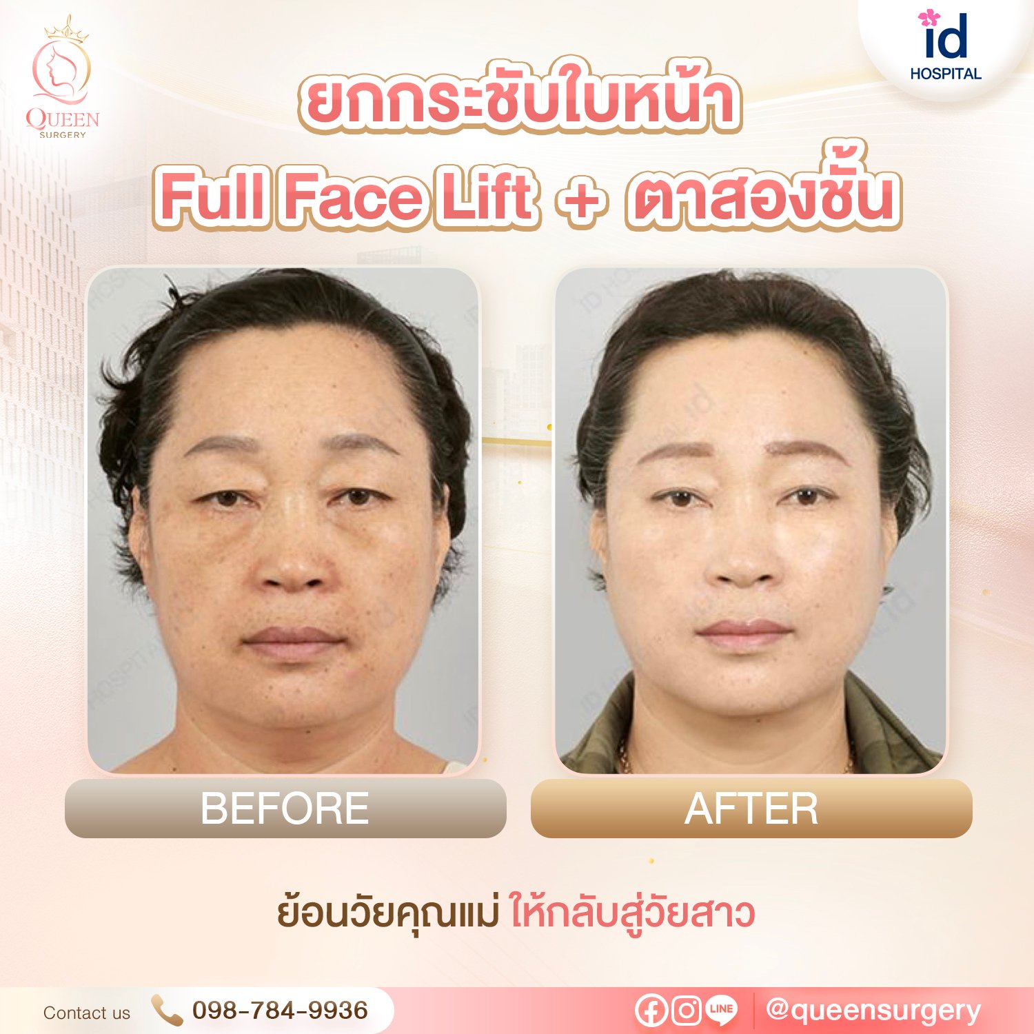 ทำไมต้อง ทำตา + เอ็นโดไทน์ กับ Queen Surgery