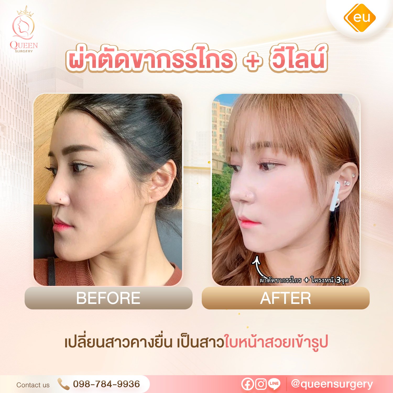 โครงหน้าสามจุด ที่สมบูรณ์แบบที่สุดสำหรับคุณ Queen Surgery